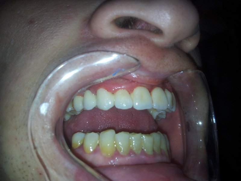 Punte dentara din ceramică Vita pe structură metalică