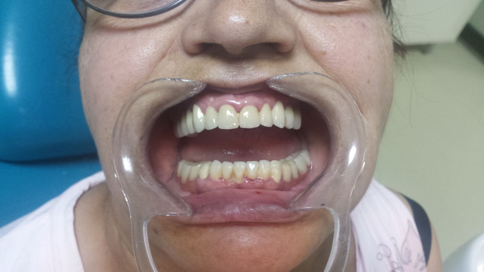 Punte metalo-ceramică superior și scheletată inferior