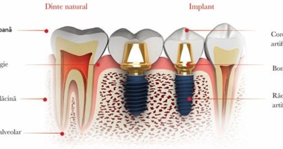 Implant dentar MegaGen AnyRidge