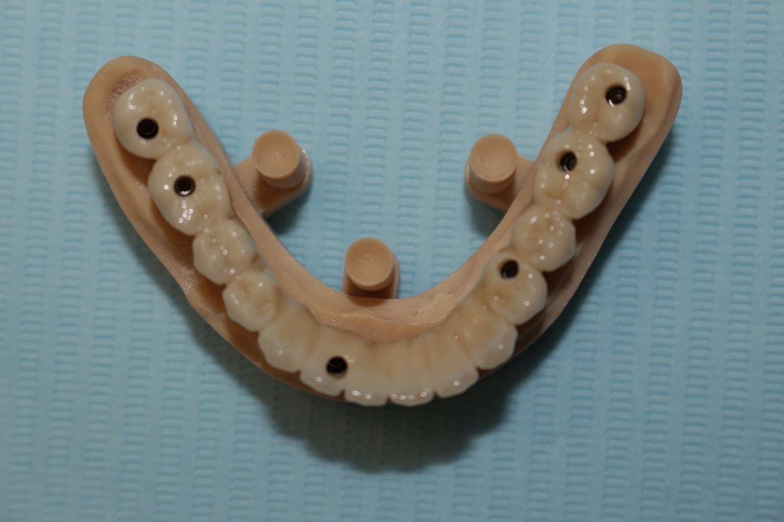 Lucrare protetică fixă pe 6 implanturi