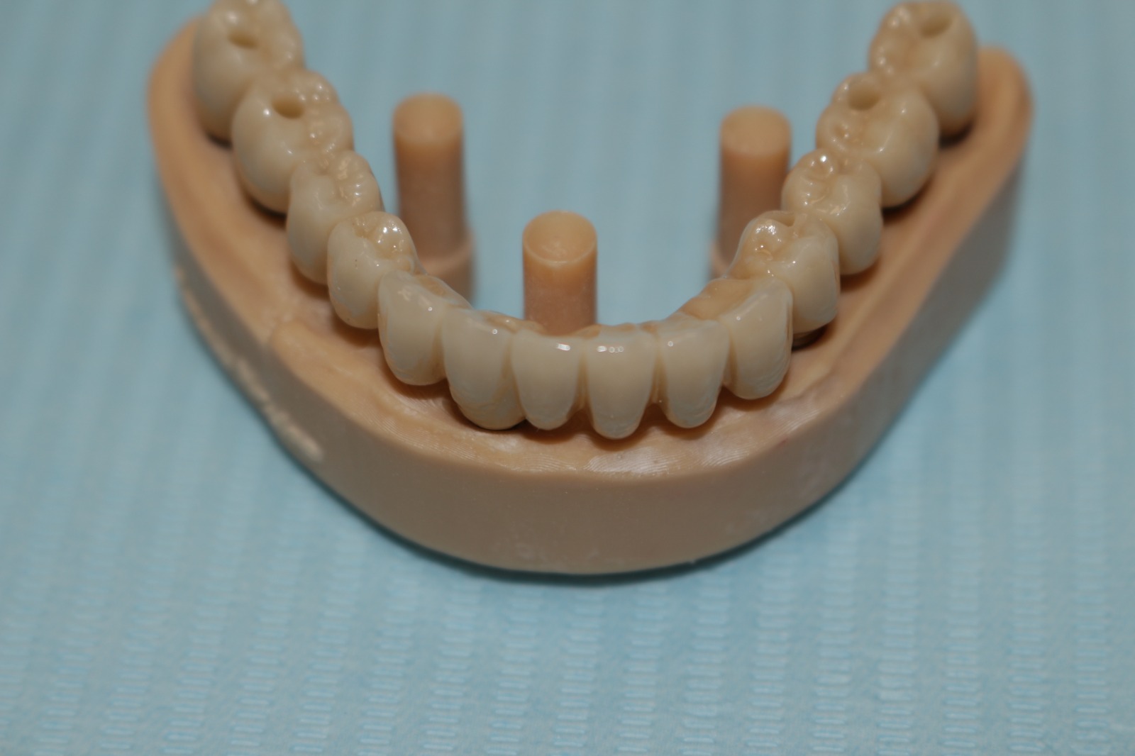 Lucrare protetică fixă pe 6 implanturi